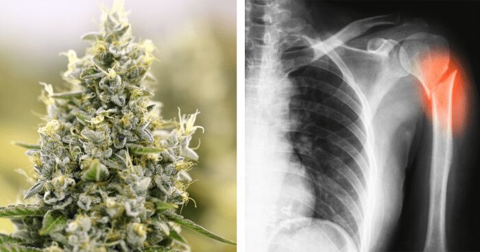 Here’s What Marijuana Does To Broken Bones - Sociedelic